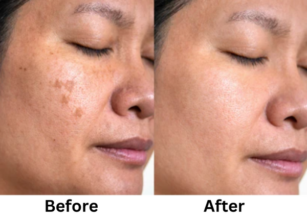 Addressing Hyperpigmentation from Summer Sun Exposure - AbsoluteJOI ...